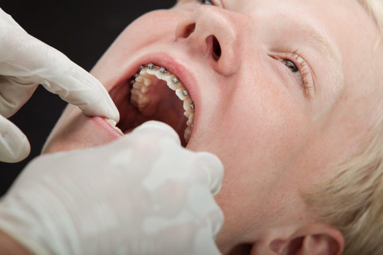 What Is 2-phase Orthodontic Treatment? - Labbe Family Orthodontics