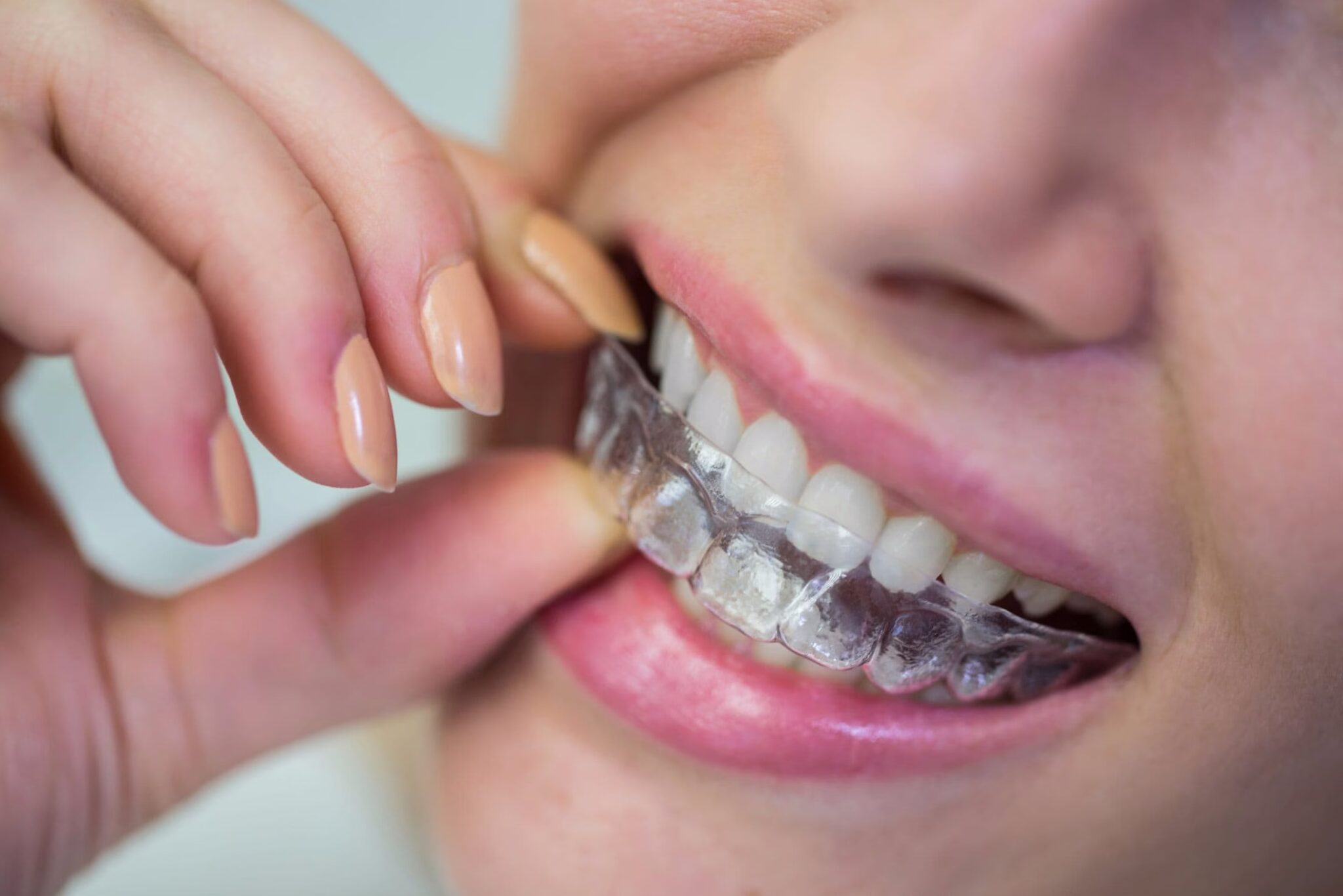 Orthodontists in Annapolis, MD Providing Advanced Care | Labbe Family ...
